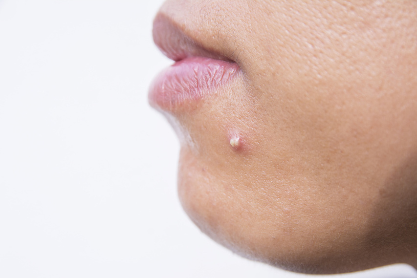 How To Get Rid Of Acne On The Chin New Guide MDacne How To Get Rid Of Acne On The Chin New Guide MDacne