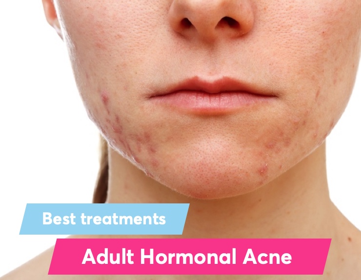 Best Treatments For Adult Acne According To Dermatologists Mdacne