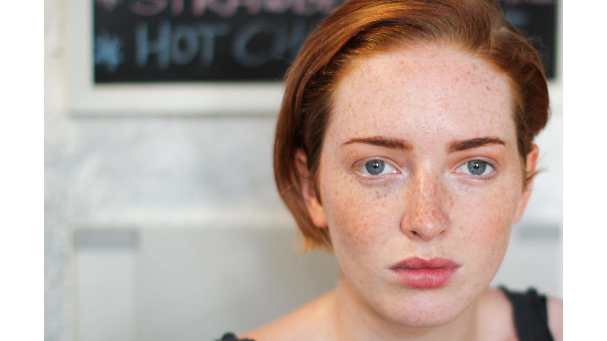 Stress acne: best treatments according to dermatologists | MDacne