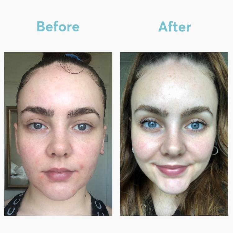 Customized Skin Clearing Supplements | MDacne
