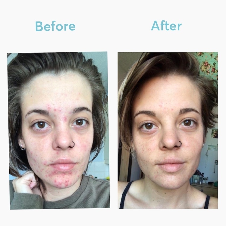 DIM Skin Clearing Supplements | MDacne