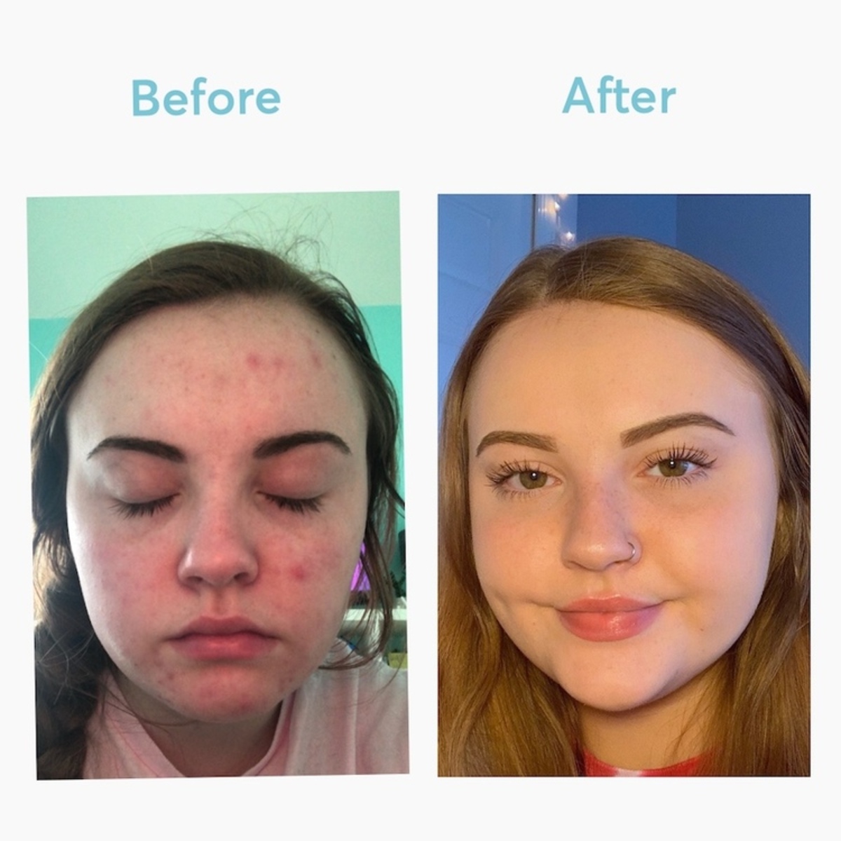 Skin Clearing DIM Supplements | MDacne