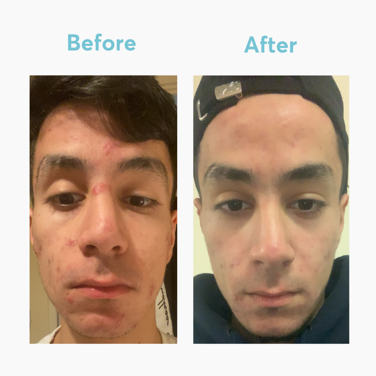 Sulfur 3.0% Treatment Cream | MDacne
