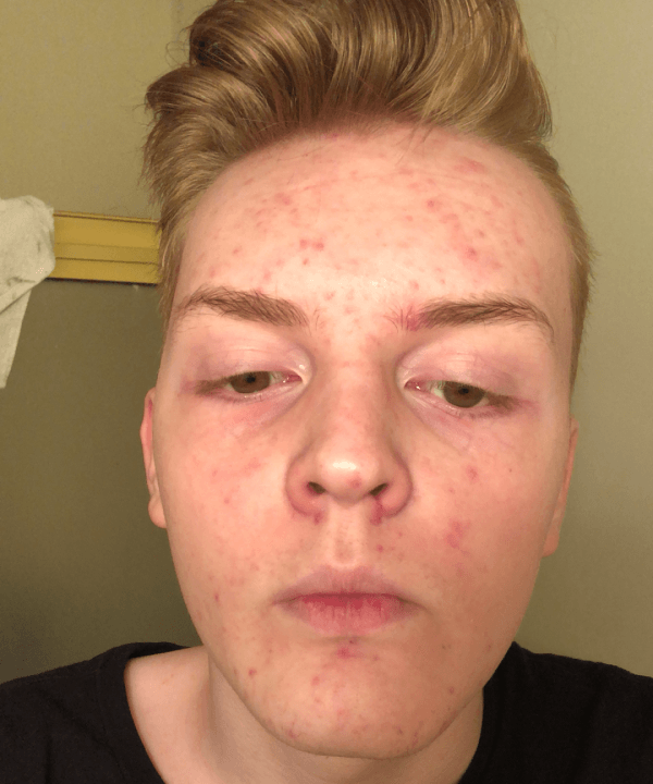 MDacne - Get Clear Skin with a Custom Acne Treatment