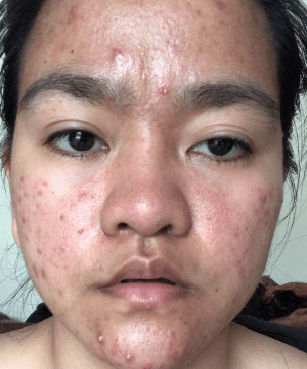 MDacne - Get Clear Skin with a Custom Acne Treatment
