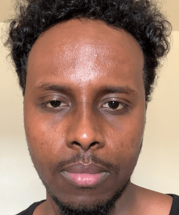 MDacne Reviews and Before and After Results