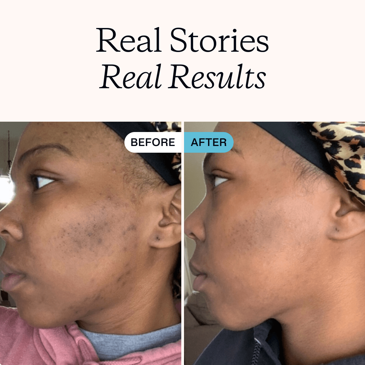 Retinol Treatment System | MDacne