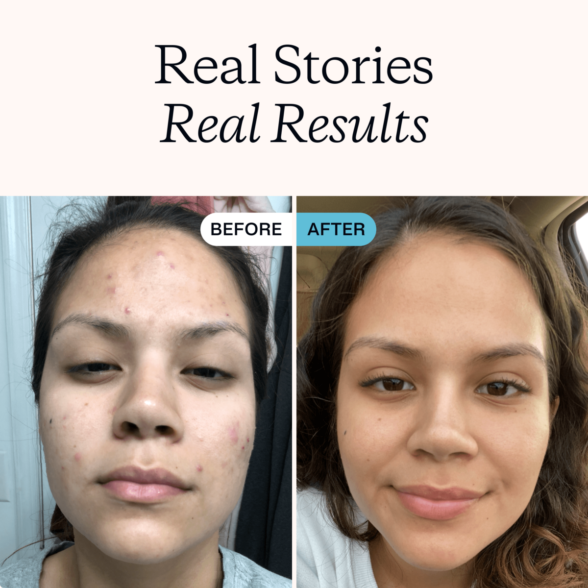 Retinol 0.25% Treatment Cream | MDacne