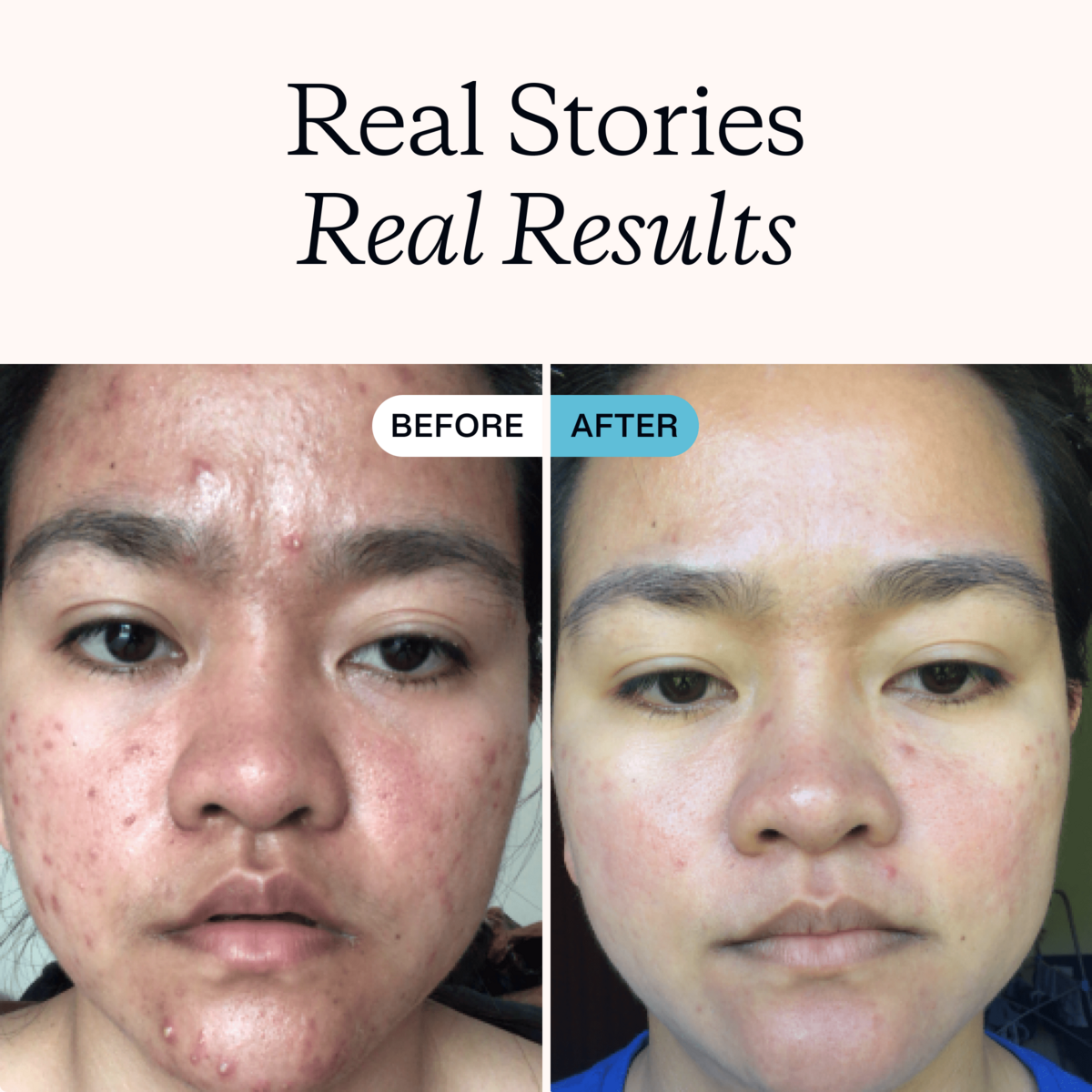 Salicylic Acid 2.0% Treatment Cream | MDacne